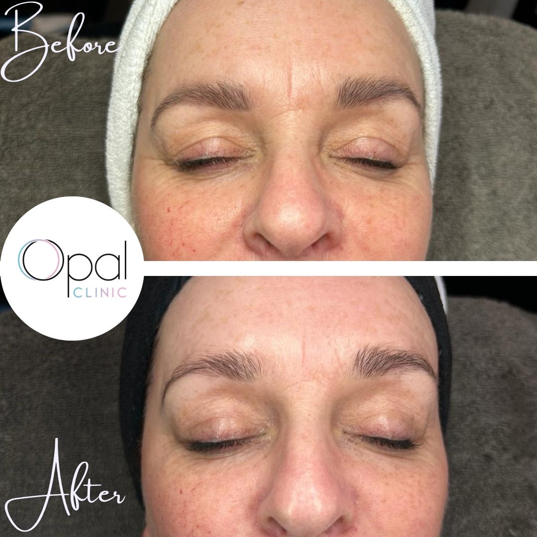Before & After Gallery - Opal Clinic Falkirk - Professional Skincare ...